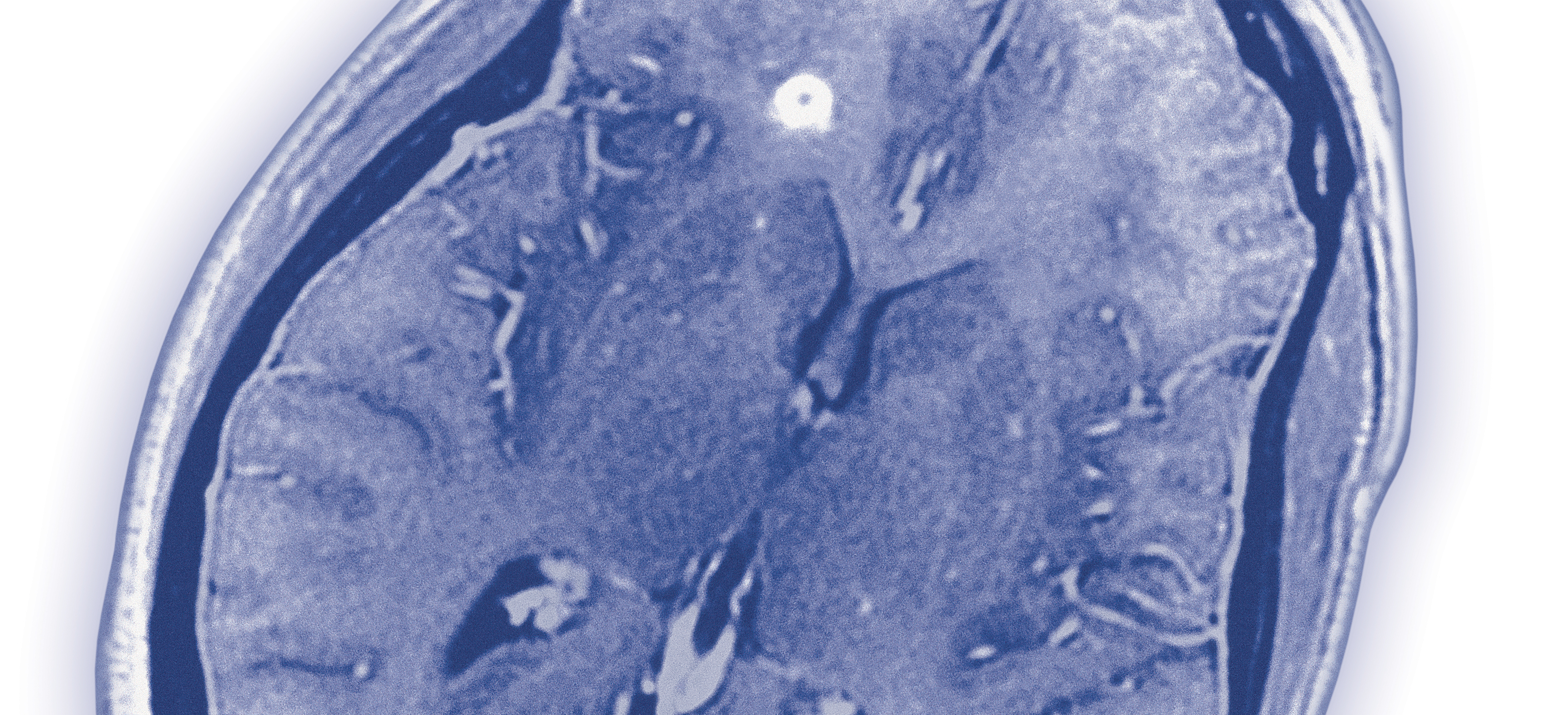 Primær progressiv multipel sclerose – symptomer og diagnose